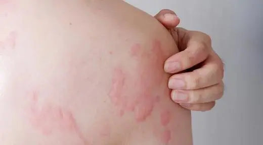 Understanding Welts: Causes, Symptoms and Treatments - Classic Derma ...